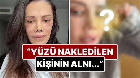 Didem Ceranın Yüzündeki Değişiklik Şoke Etti Onedio