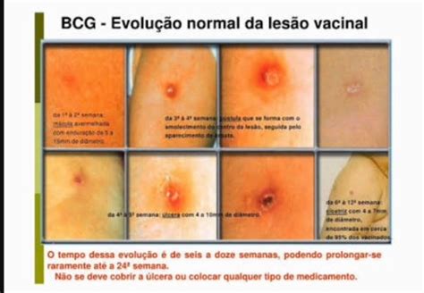 Bcg Bebe 1 Mois Le Calendrier Des Vaccins De 1 à 6 Ans Fjehc
