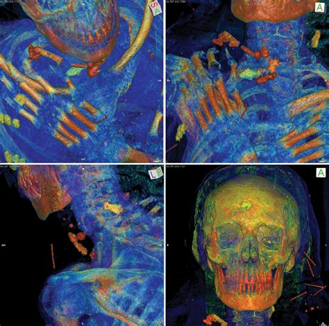 A Critical Look At Mummy Ct Scanning Cox 2015 The Anatomical