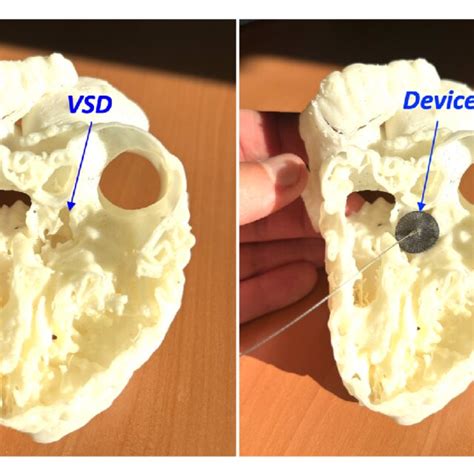 A 3d Printed Model Of Perimembranous Ventricular Septal Defect Vsd Download Scientific