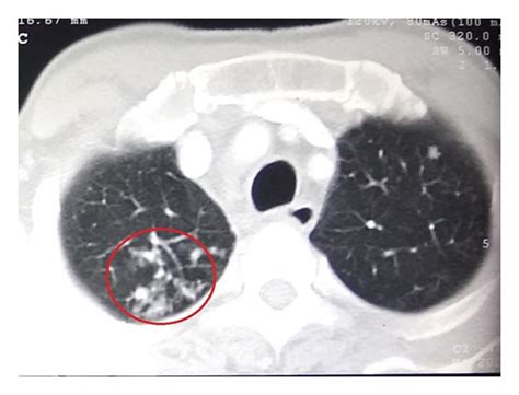 Contrast CT Showing Tree In Bud Appearance In The Right Upper Lobe Download Scientific
