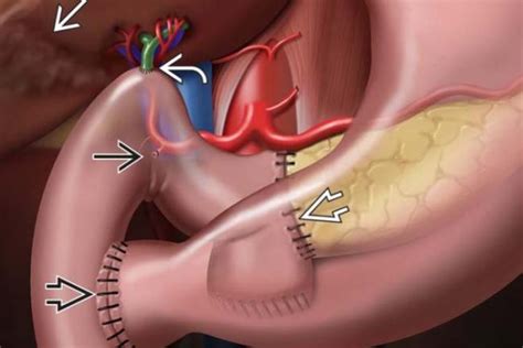 Hepatobilliary Surgeries Dr Major Ramesh Das