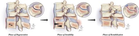 Evolution Of Lumbar Degenerative Spondylolisthesis With Key