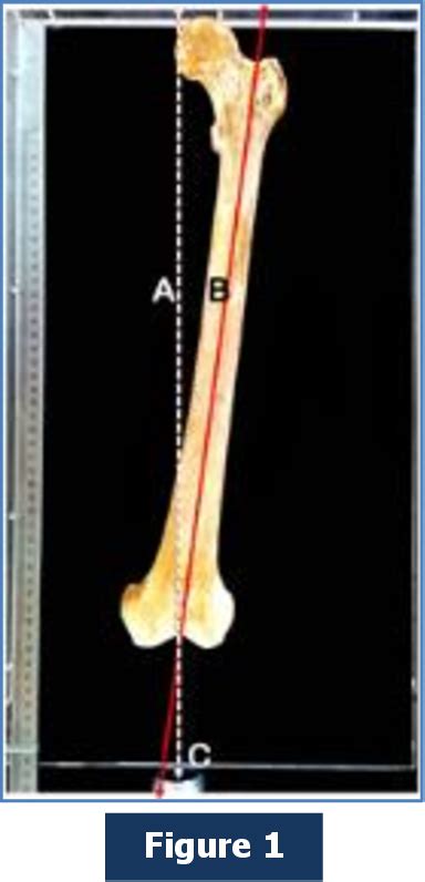 Figure 1 From Identifying The Rotational Axes Of Distal Femur In South Andhra Population Of