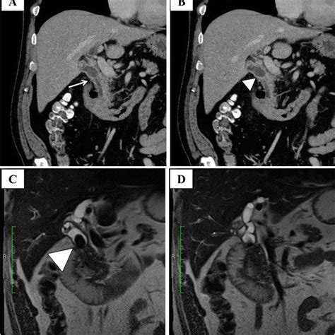 Preoperative Cholangiography Through An Enbd Tube Preoperative