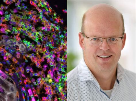 Ductal Carcinoma In Situ When Cancer Isnt Really Cancer