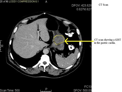 Gastrointestinal Stromal Tumor CT Wikidoc