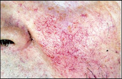 Figure 110 From An Investigation Of The Role Of Bacillus Oleronius In