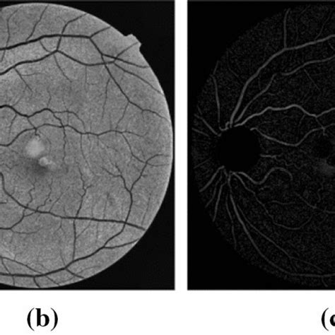 Process In Candidate Extraction A Contrast Enhancement B Download Scientific Diagram