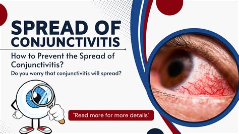 How To Prevent The Spread Of Conjunctivitis Tips From The Best Eye