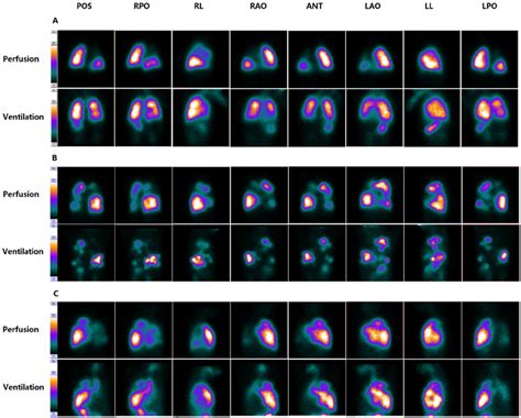Three Patterns Of V Q Scan A Mismatched Ventilation B Mismatched Download Scientific