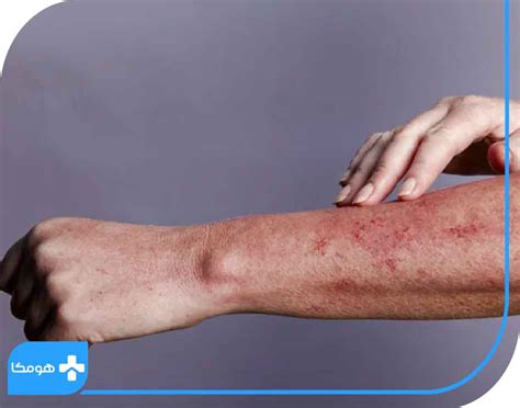 علائم پوستی ایدز چیست؟ ویرگول