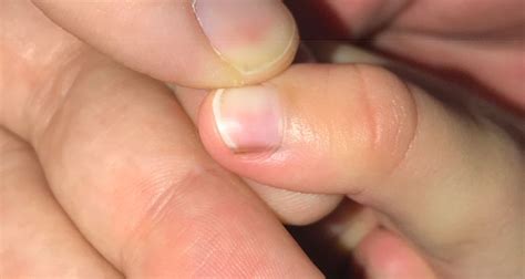 Small Black Spot On Toe