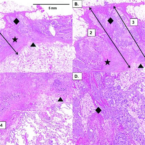 He Images Demonstrating Histologic Parameters Of Pm Pleural Rind