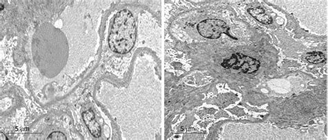 Electron Microscopy Extensive Effacement Of Podocyte Foot Processes Download Scientific