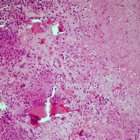 Pdf Primary Tuberculosis Osteomyelitis Of Rib