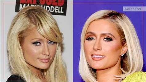 Nose Job Celebrities Before After