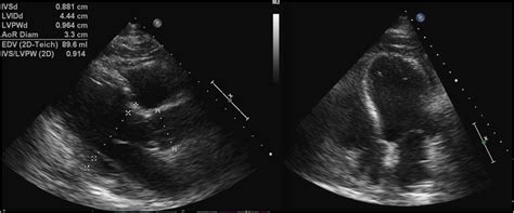 Normal Vs Abnormal Echocardiogram