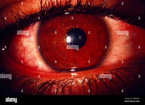 Close Up Photograph Of The Eye Showing Acute Chlamydial Conjunctivitis