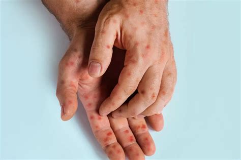 Deadly Sex Virus Cases Surge As Who Admits We Dont Know How Long This