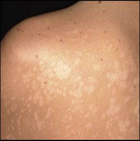 Домашни средства за премахване на бели петна върху кожата