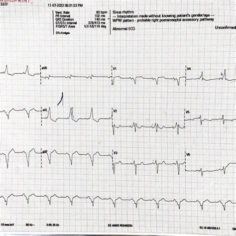Ecg Showing Atrial Flutter With 2 1 Atrioventricular Conduction The Download Scientific