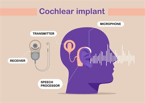 Diagnosis For Cochlear Implant At Steven Serpa Blog