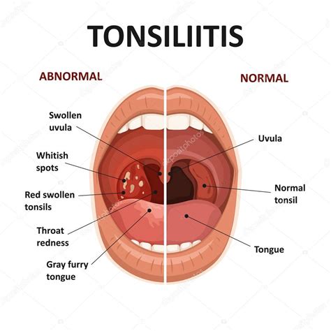 Amígdalas Y Enfermedades De La Garganta Síntomas De Amigdalitis