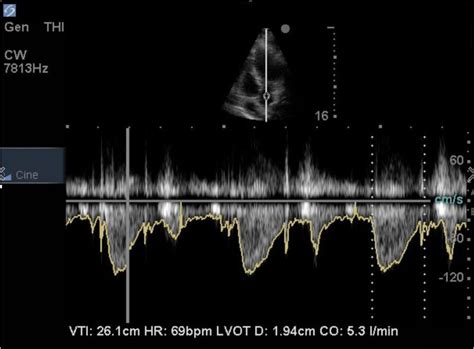 Heart Power Doppler Or Continuous Wave Doppler Through Aortic Valve