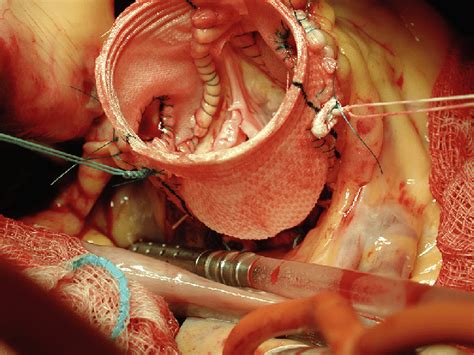 Figure E1 The Sinus Prosthesis Intraoperative View Of An Implanted Download Scientific