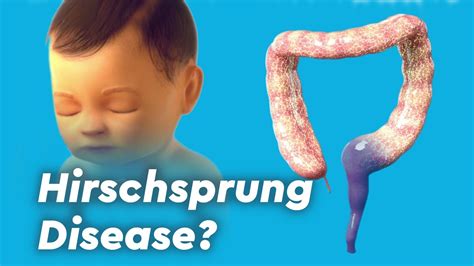 Hirschsprung Disease Colitis And Fecal Incontinence Youtube