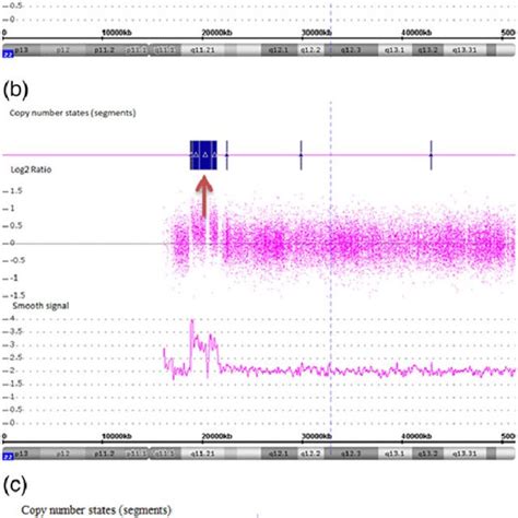Snp Microarray Results Showing Predicted Duplications Indicated By Red Download Scientific