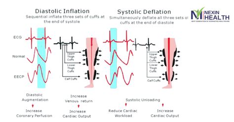 How Does Eecp Therapy Work Nexinhealth