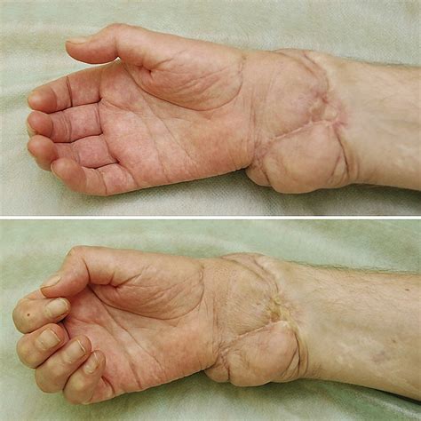 World Experience After More Than A Decade Of Clinical Hand