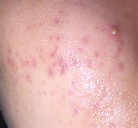 Treatment Plan For My Indented Pie And Shallow Scars Scar Treatments