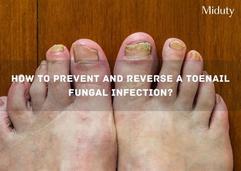 How To Prevent And Reverse A Toenail Fungal Infection