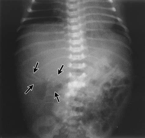 Fetus In Fetu Three Dimensional Imaging Using Multidetector Ct Ajr