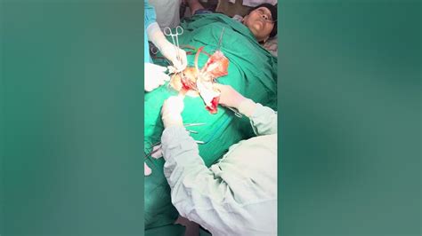 Appendisectomy Part 2 Youtube