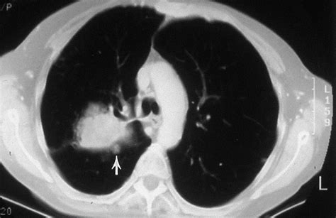 Intrapulmonary Metastasis Arrow Download Scientific Diagram