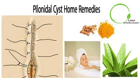 Home Remedies For Pilonidal Sinus Dr Zahra Saadati Laser Surgery