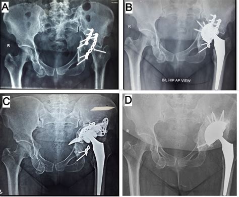 Management Of Chronic Pelvic Discontinuity During Revision Hip Arthroplasty Using The