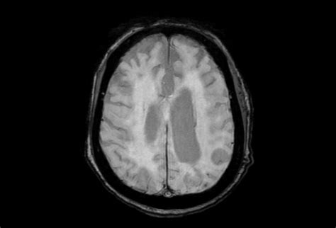 Cerebral Amyloid Angiopathy Radiopaedia 86671 102792 Axial Gradient