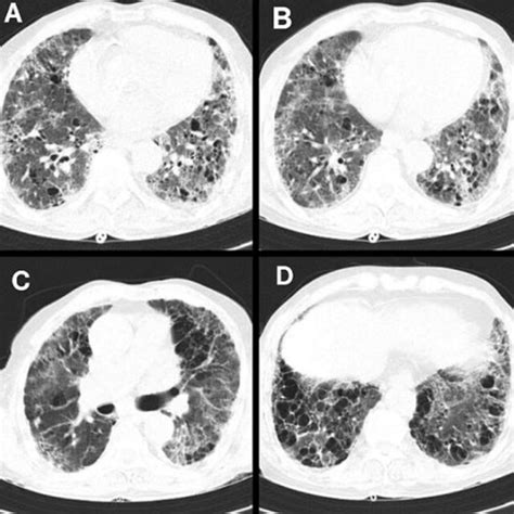 Hrct Scan Of The Thorax A And C Tractional Bronchiectasis And Download Scientific Diagram