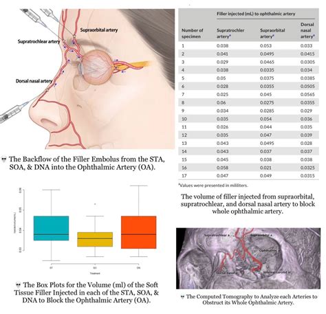 Yousef Nazari On Linkedin 💀 The Backflow Of The Soft Tissue Filler Embolus From The