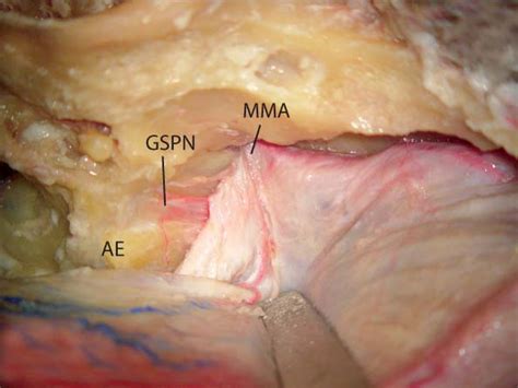 17 Total Petrosectomy With Partial Clivectomy Neupsy Key