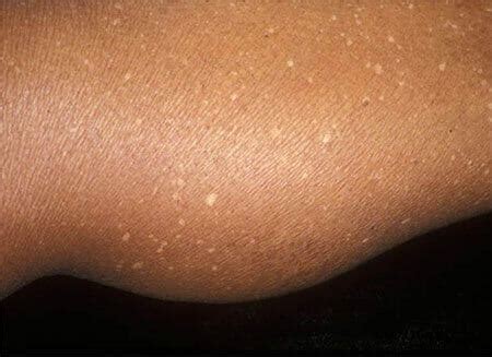 Idiopathic Guttate Hypomelanosis
