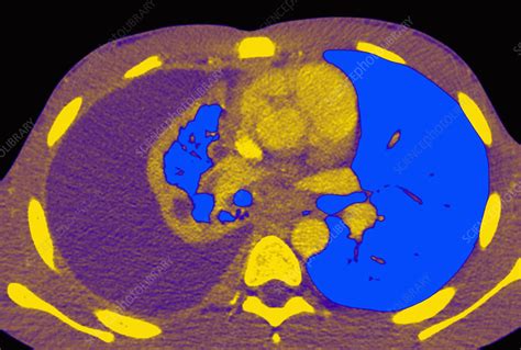 Pleurisy Ct Scan Stock Image C0500890 Science Photo Library