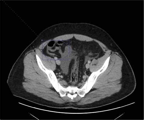 A Hyperemic And Inf Lamed Appendix Can Be Seen Without An Abscess Download Scientific Diagram