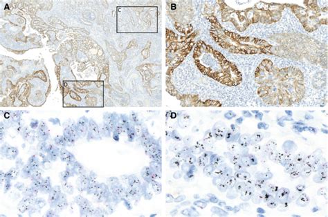 Performance Of A Her2 Testing Algorithm Specific For P53 Abnormal