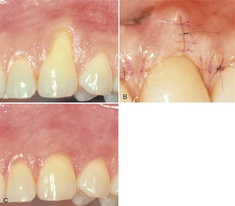 64 Periodontal Microsurgery Pocket Dentistry